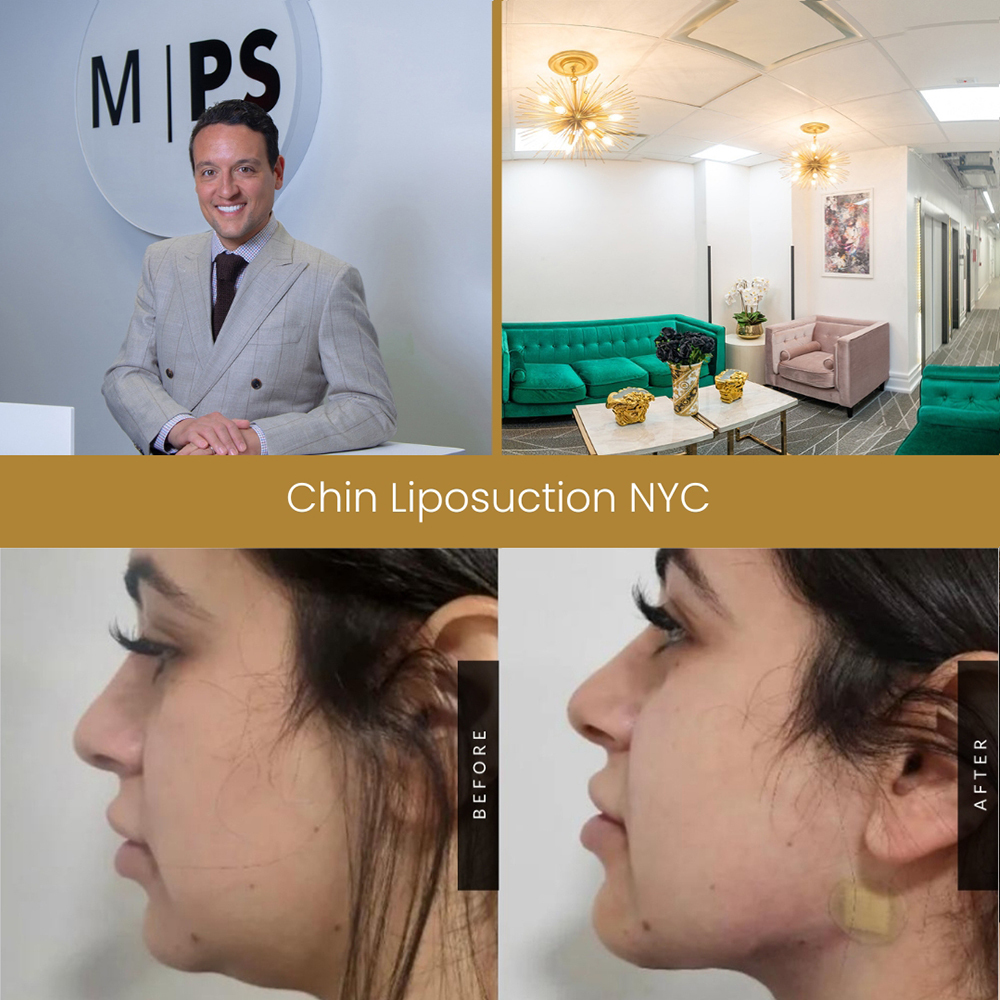 Chin Liposuction In Nyc Chin Fat Removal Manhattan Bronx