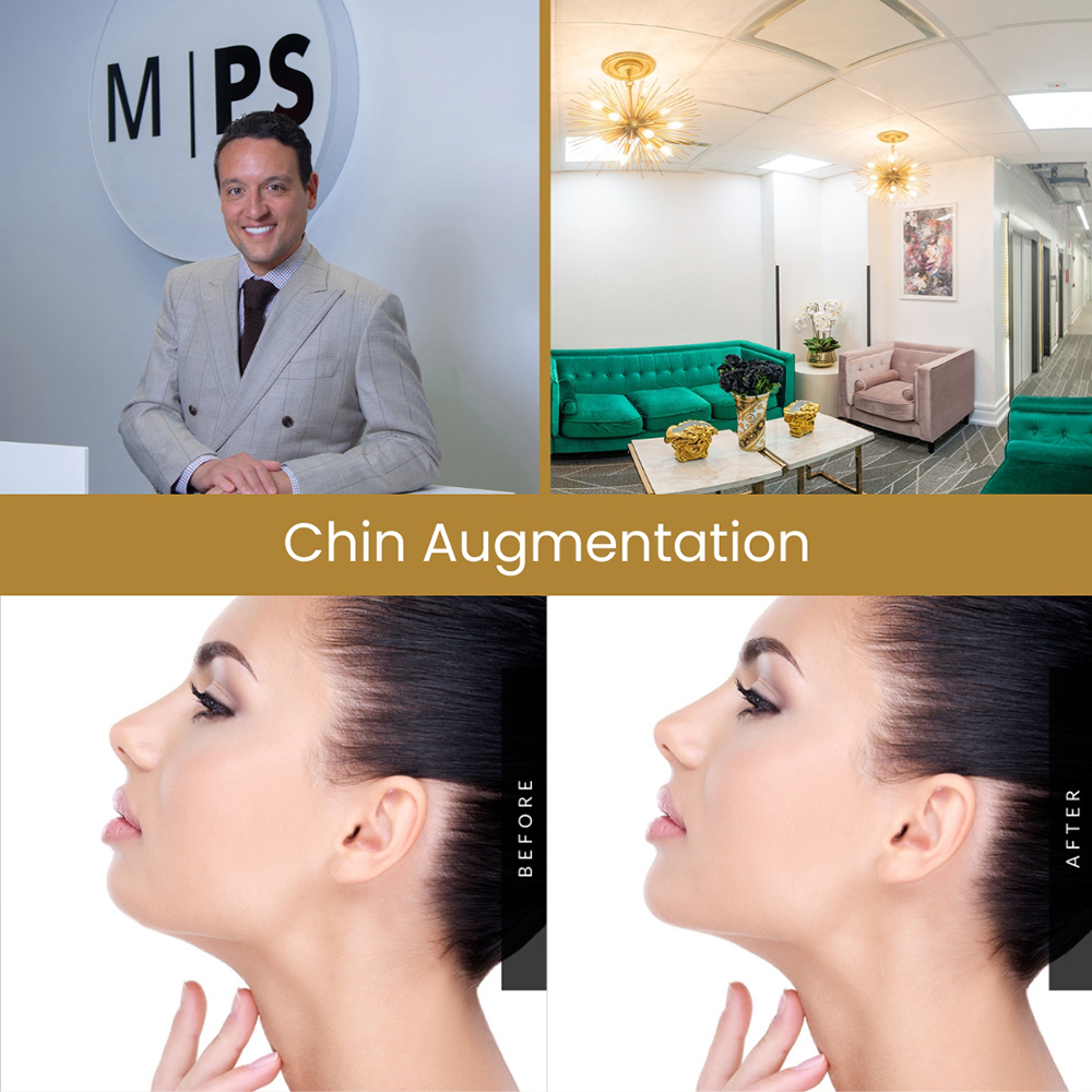 Chin Augmentation Before and After Photos | Millennial Plastic Surgery