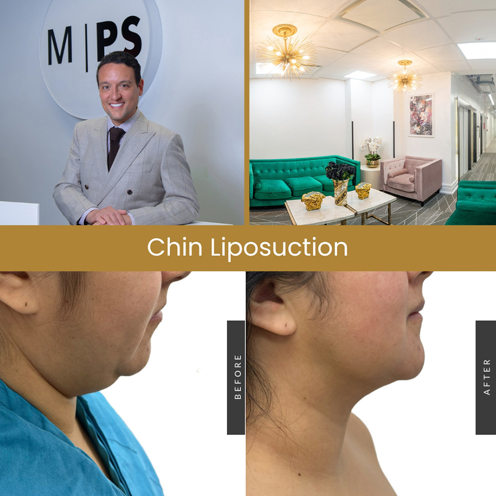 Chin Liposuction Before and After Photos | Millennial Plastic Surgery