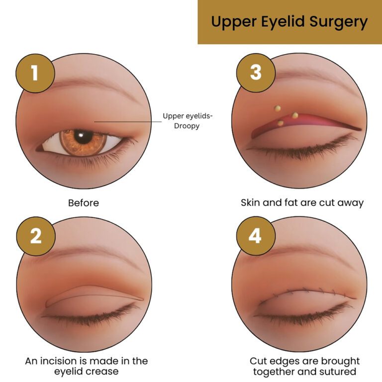 Upper Eyelid Surgery NYC | Eyelid Lift Surgery New York City